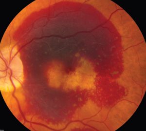 North Houston Eye Care: Age Related Macular Degeneration in Texas