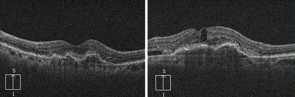 North Houston Eye Care: Age Related Macular Degeneration in Texas