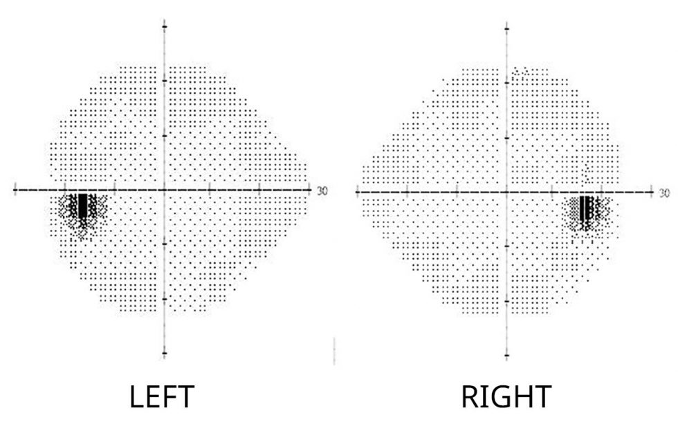 Glaucoma: Testing & Treatment, North Houston Eye Care: Eye Surgery in ...