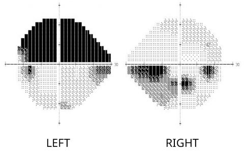 Glaucoma: Testing & Treatment, North Houston Eye Care: Eye Surgery in ...