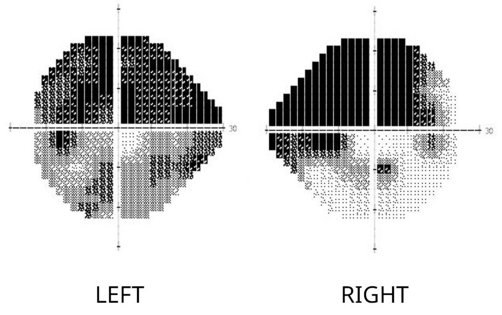 Glaucoma: Testing & Treatment, North Houston Eye Care: Eye Surgery in ...