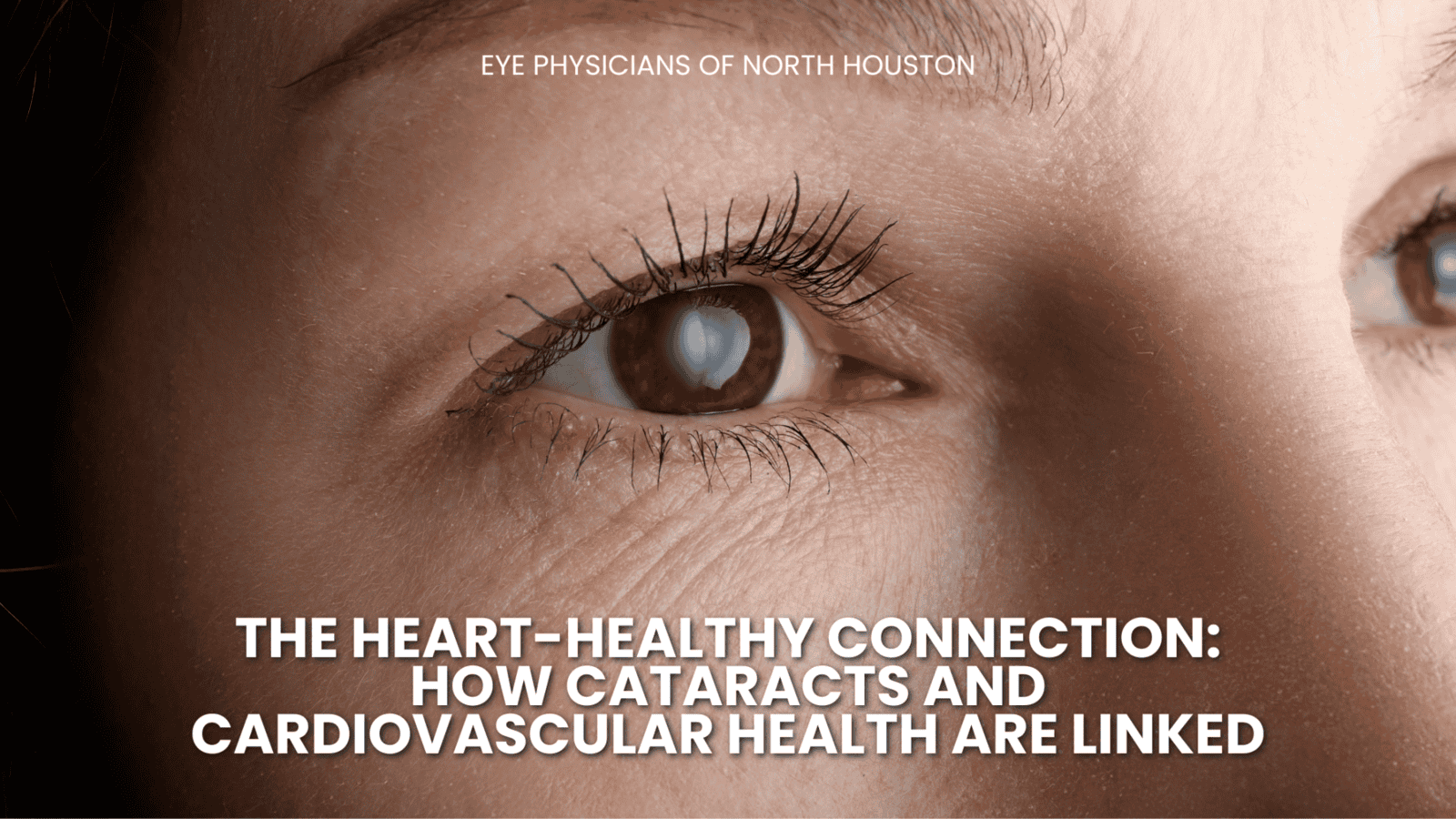 The Heart-Healthy Connection: How Cataracts and Cardiovascular Health ...